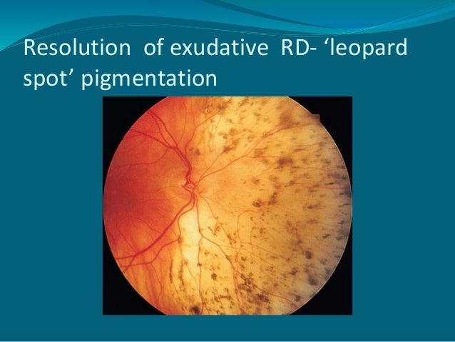 Retinal detachment