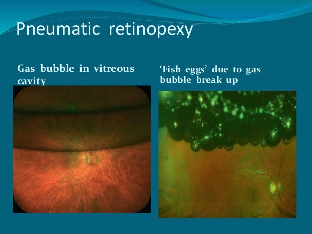 Retinal detachment