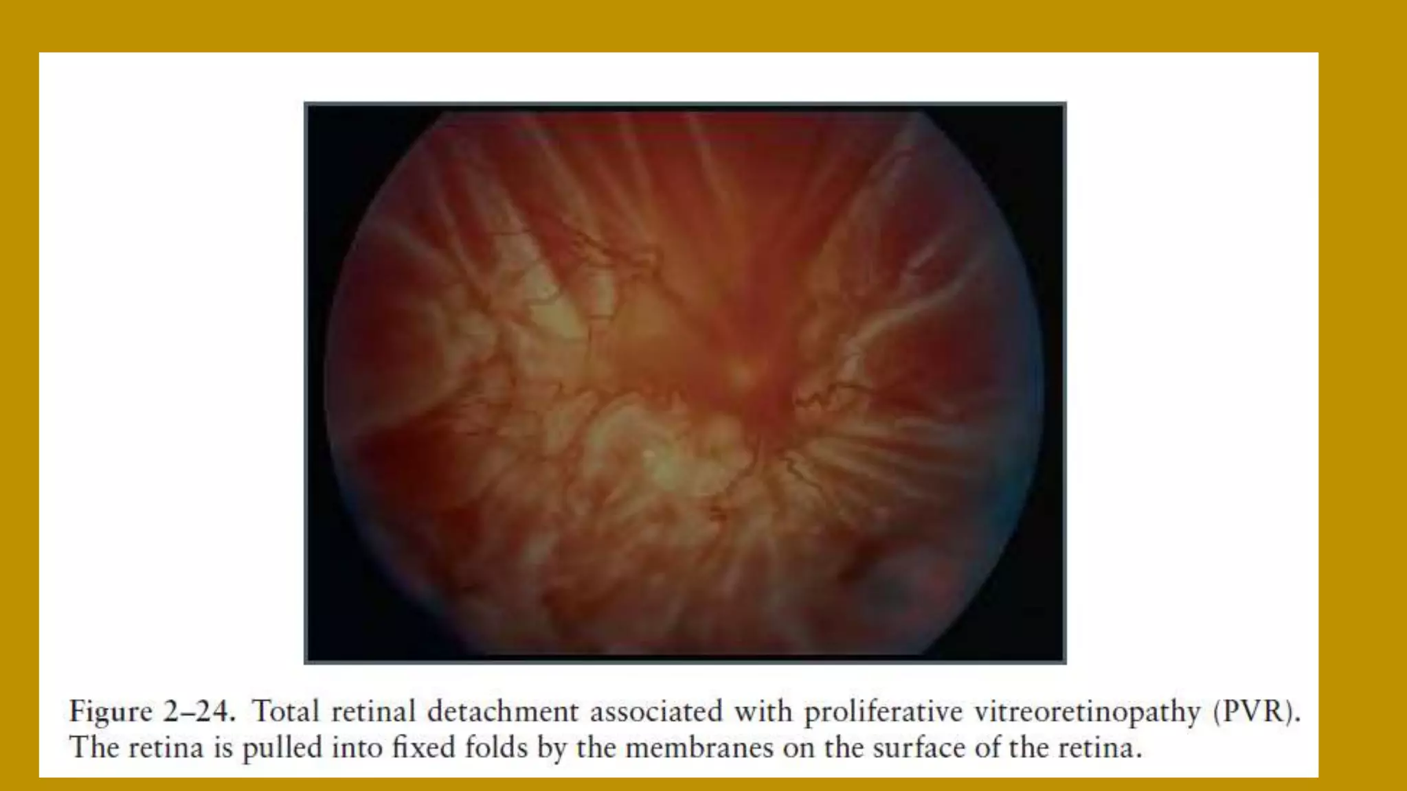 Retinal detachment 2016 | PPTX