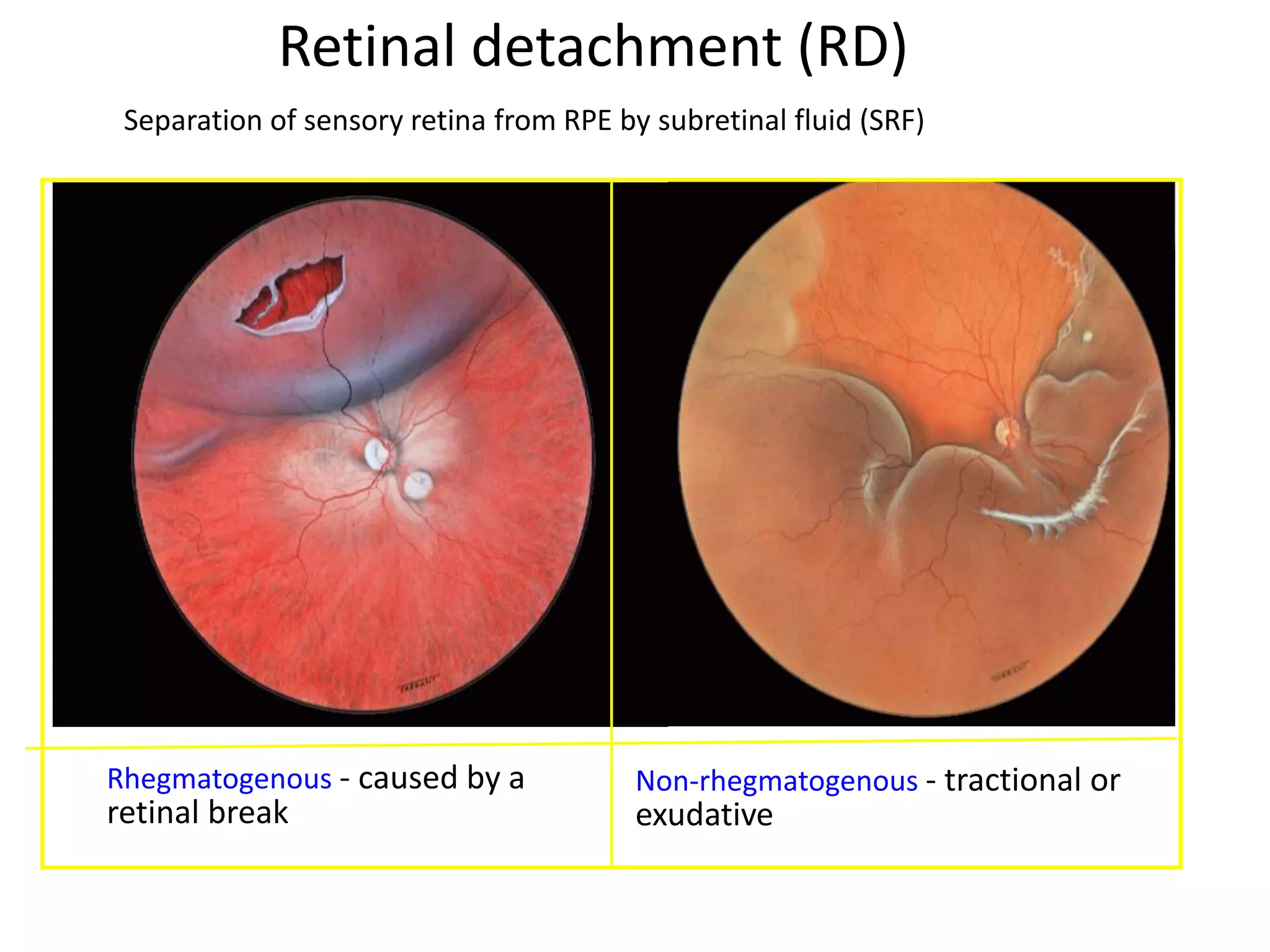 retinal_detachment 4.pptx