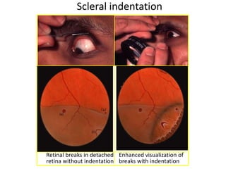 retinal_detachment 4.pptx