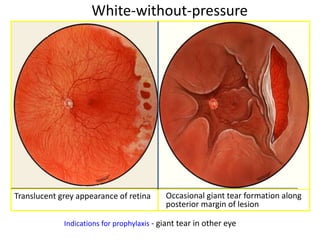 retinal_detachment 4.pptx