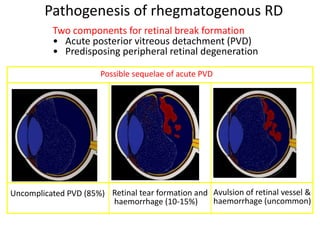 retinal_detachment 4.pptx