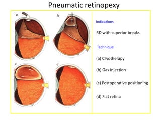 retinal_detachment 4.pptx