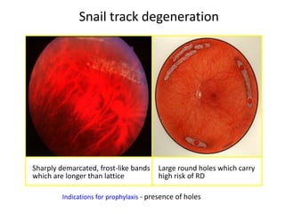 Snail Track Degeneration