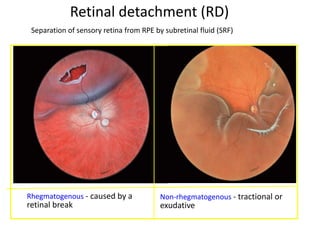 Non Rhegmatogenous Retinal Detachment