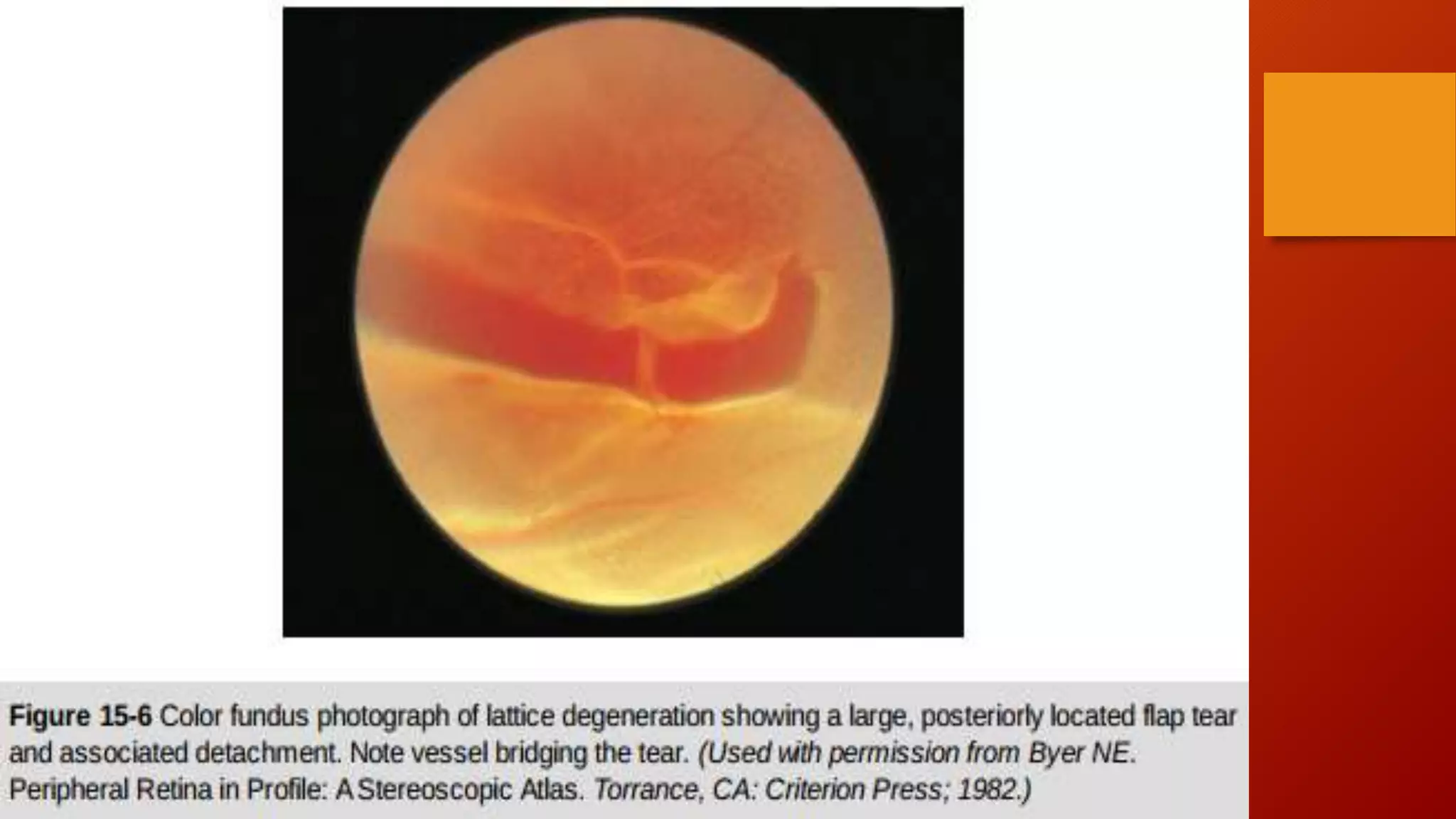 RETINAL DETACHMENT AND PREDISPOSING LESIONS lecture by Iddi.pptx
