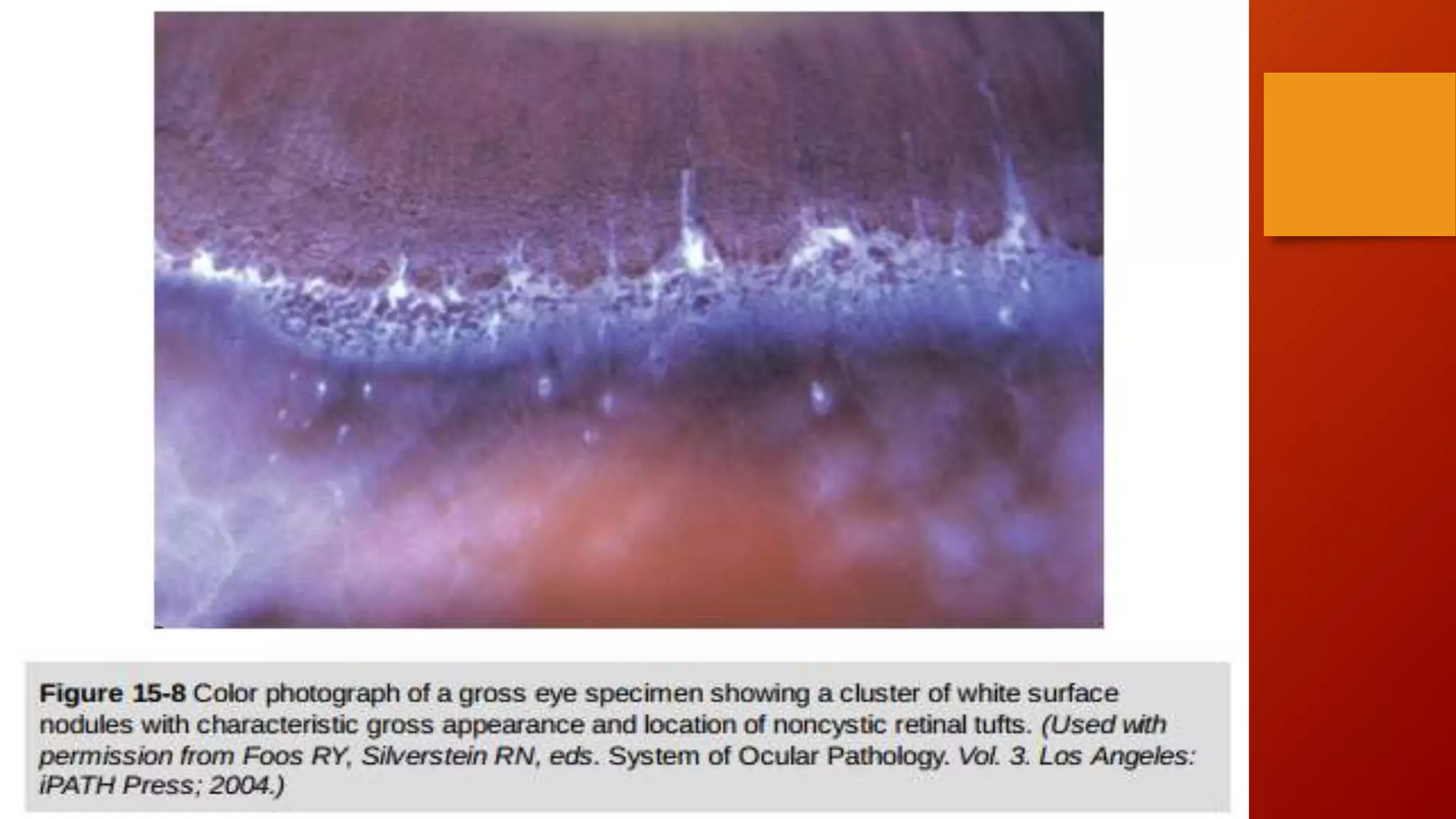 RETINAL DETACHMENT AND PREDISPOSING LESIONS lecture by Iddi.pptx