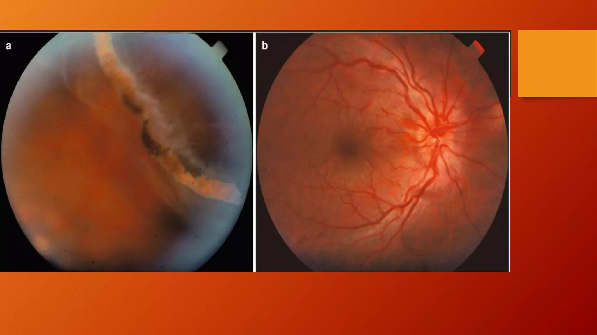 RETINAL DETACHMENT AND PREDISPOSING LESIONS lecture by Iddi.pptx