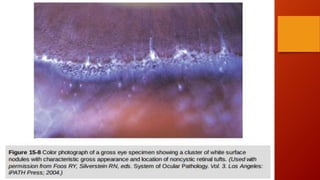 RETINAL DETACHMENT AND PREDISPOSING LESIONS lecture by Iddi.pptx