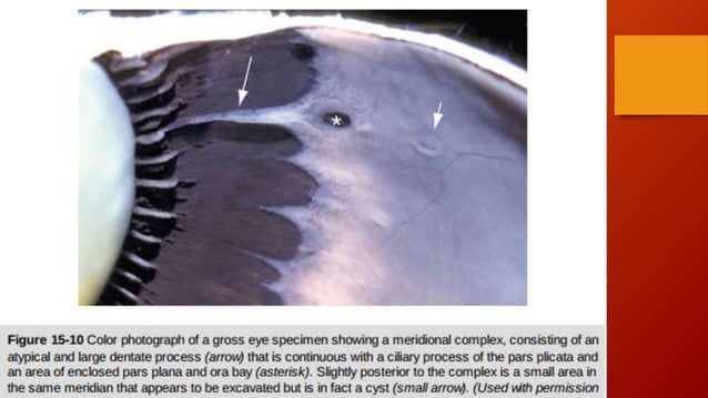RETINAL DETACHMENT AND PREDISPOSING LESIONS lecture by Iddi.pptx | Eye ...