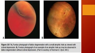 Atrophic Retinal Hole
