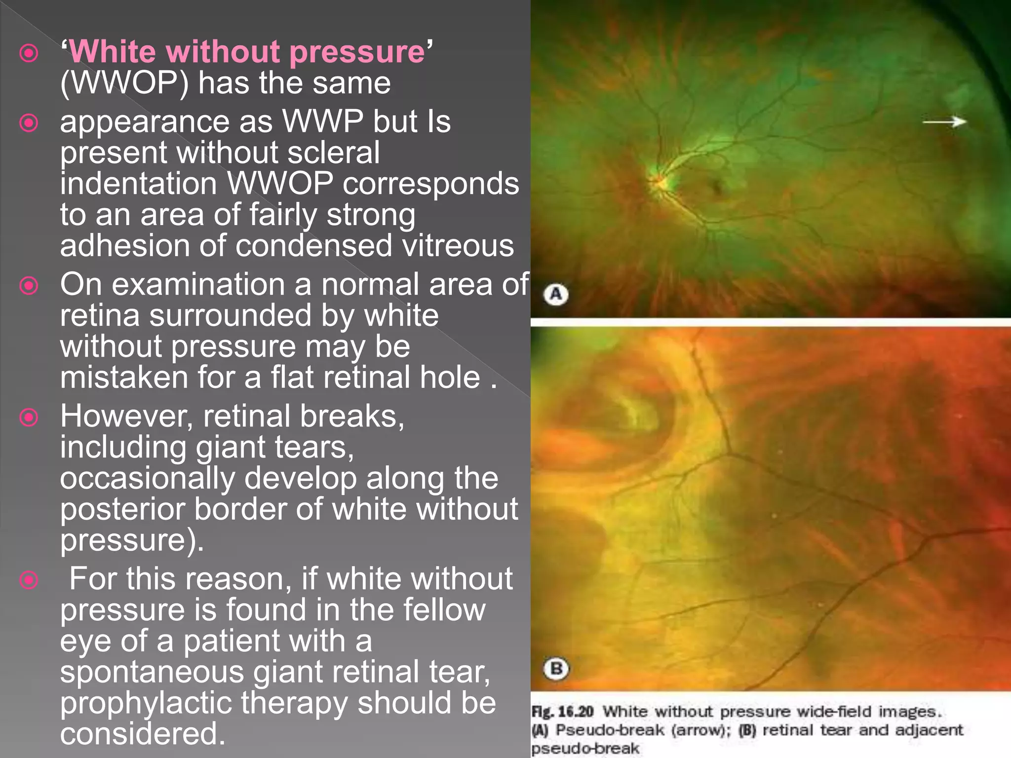 Retinal detachment | PPTX