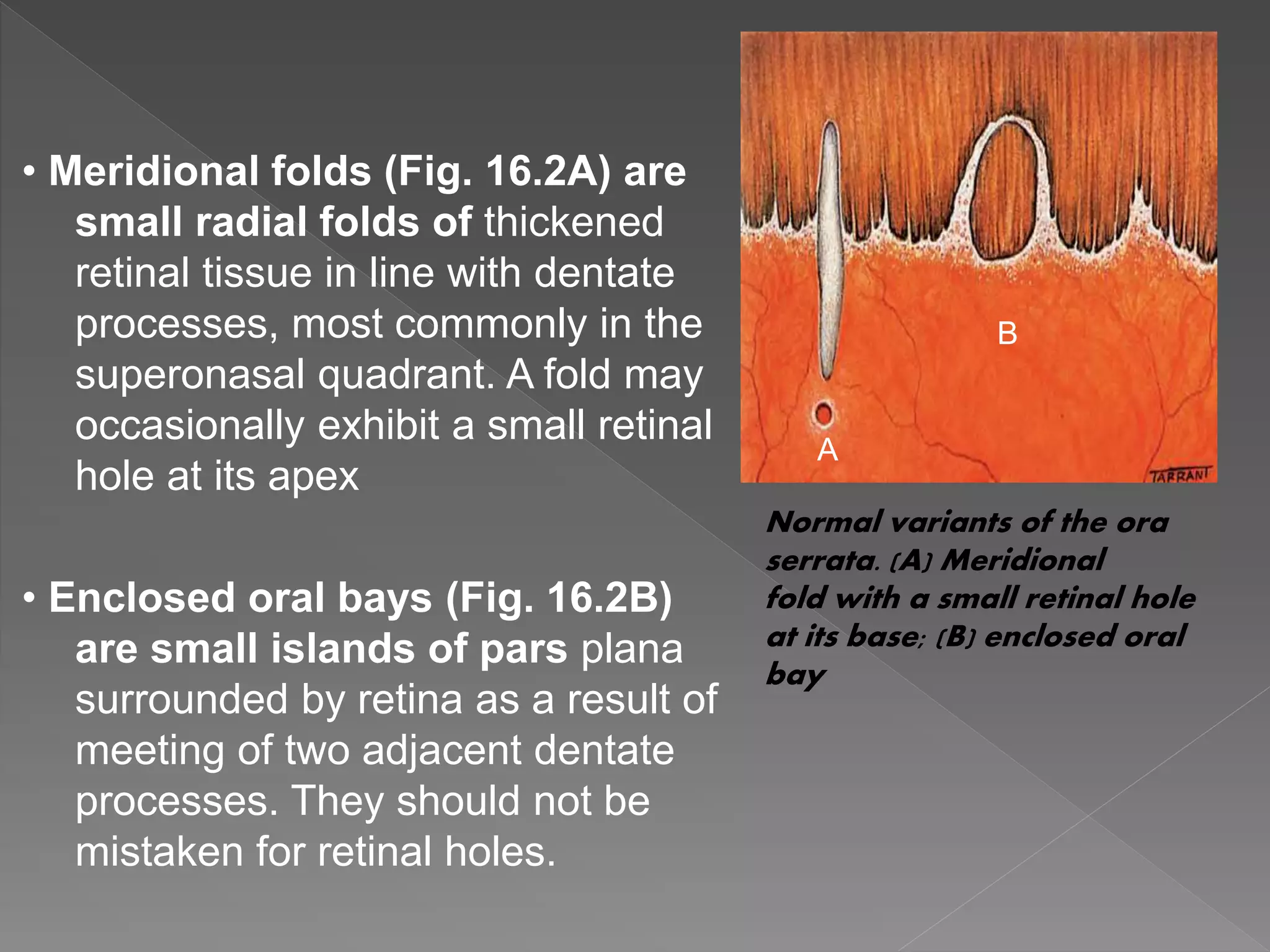 Retinal detachment | PPTX