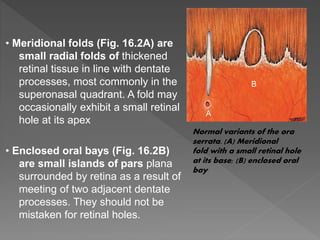 Retinal detachment | PPT