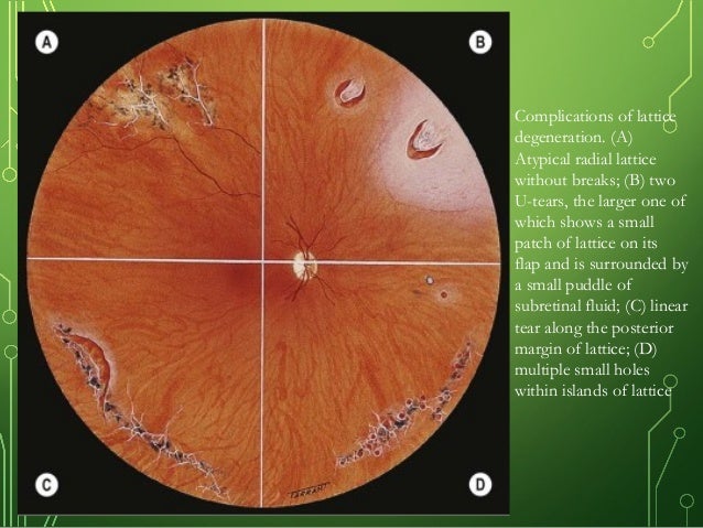Retinal detachment kalpana