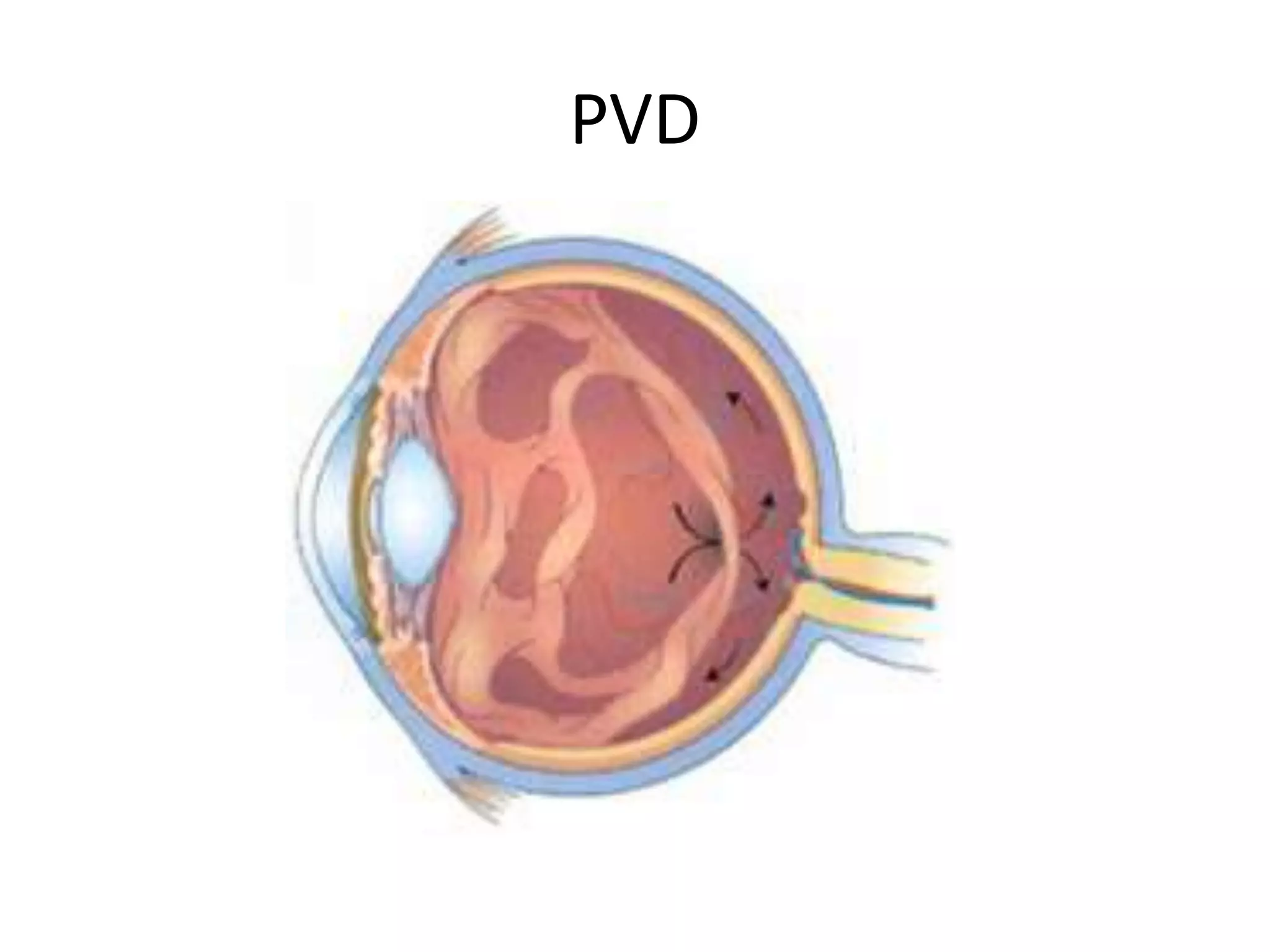 DR WANI'S TALK ON RETINAL DETACHMENT LECTURE FOR RESIDENTS [DR WANI ...