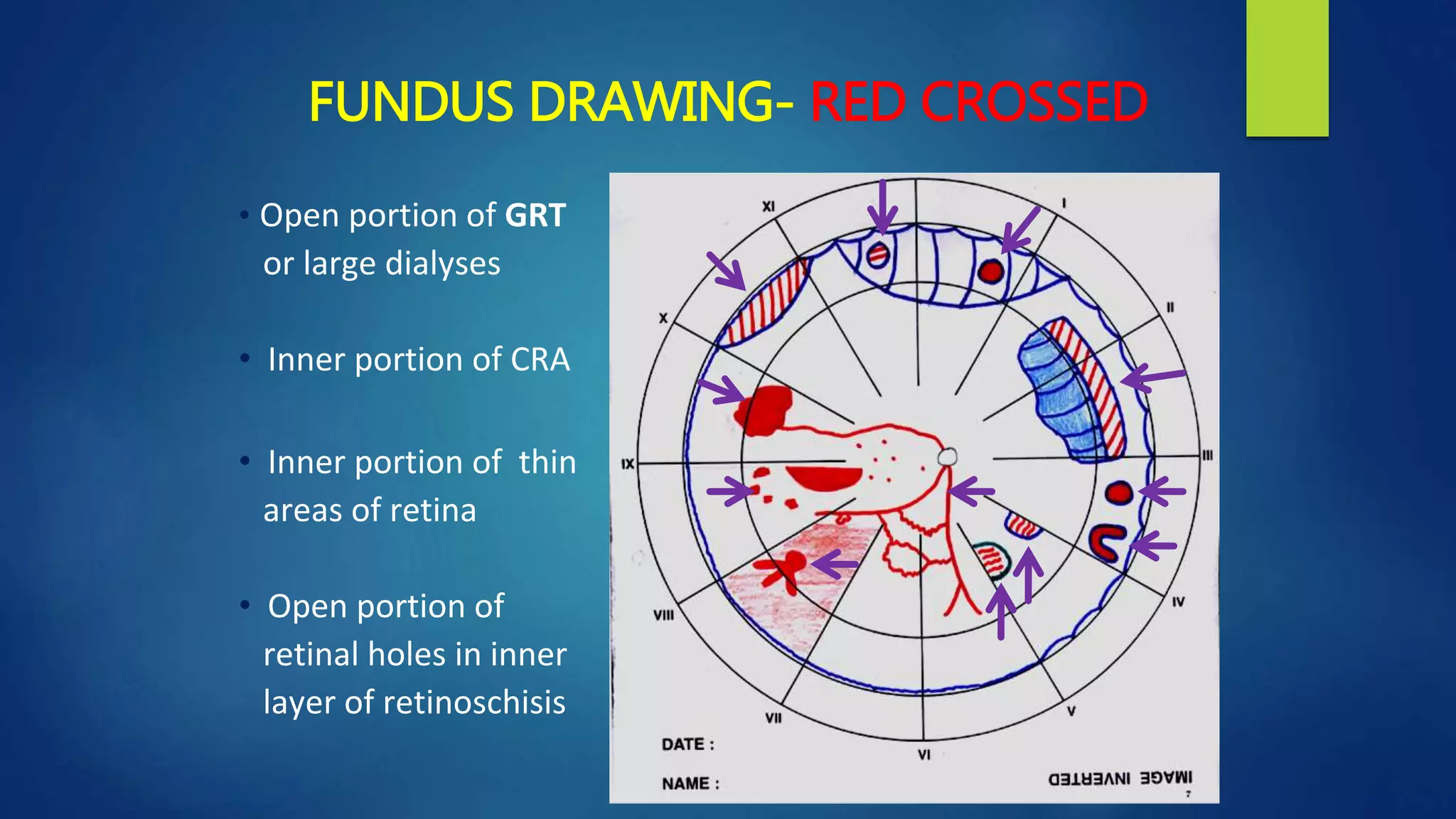 Management of retinal detachment | PPTX