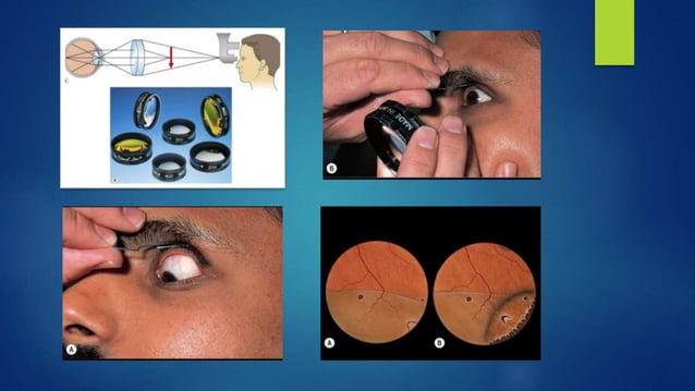 Management of retinal detachment | PPTX | Eye and Vision Conditions ...