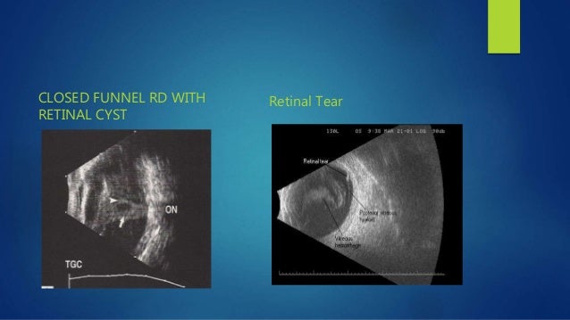 Management of retinal detachment