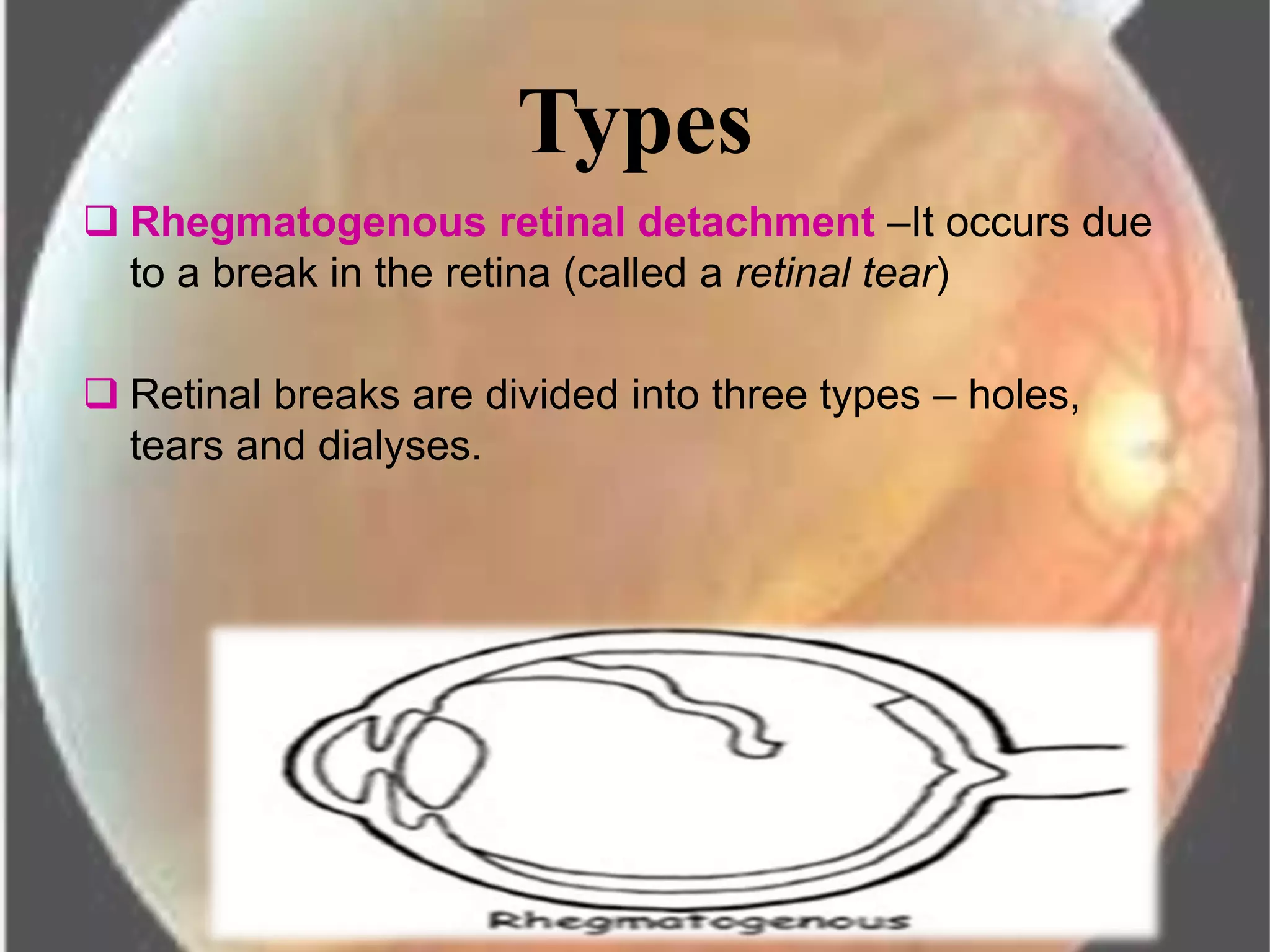 Retinal detachment new | PPTX