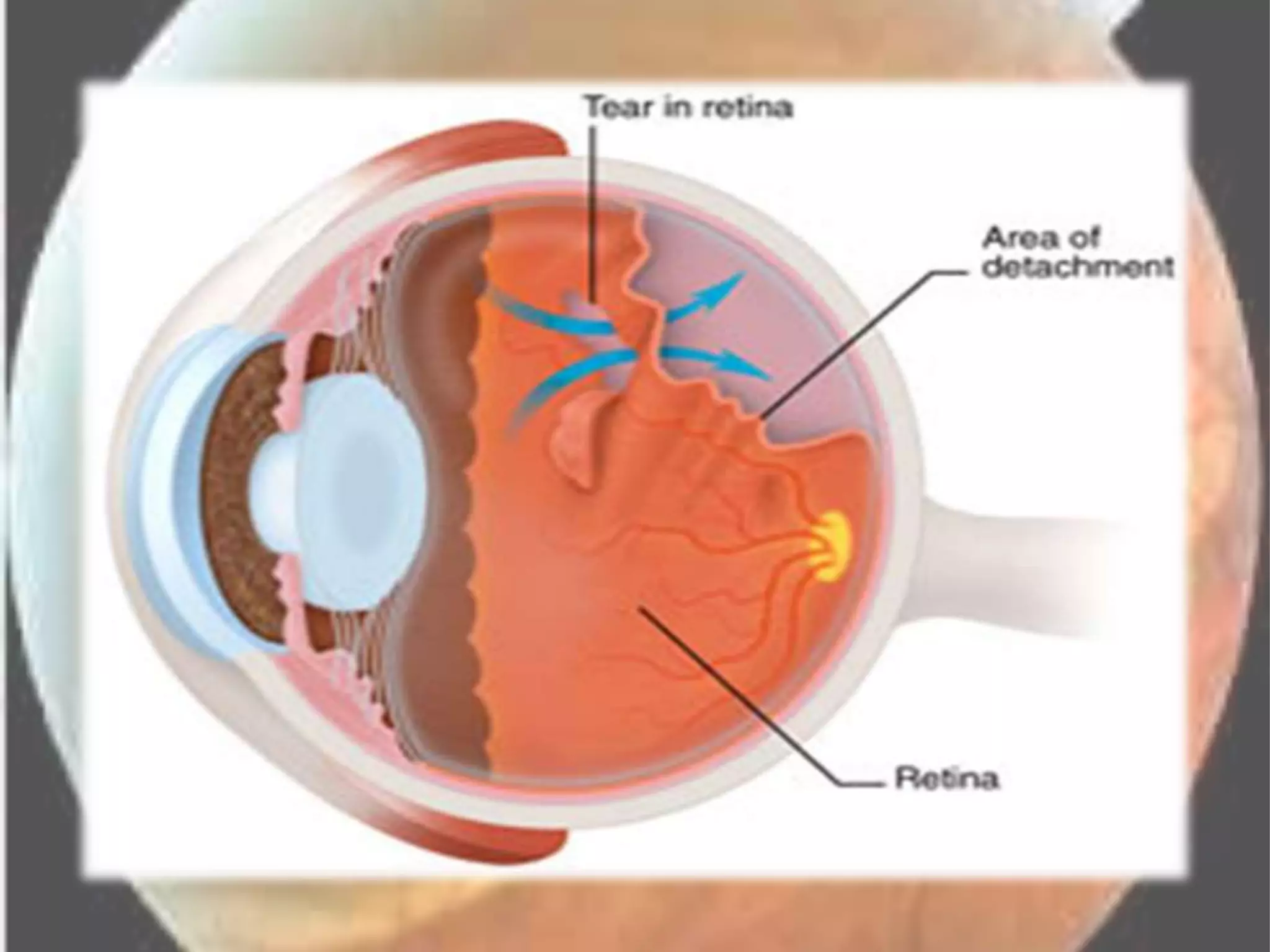 Retinal detachment new | PPTX