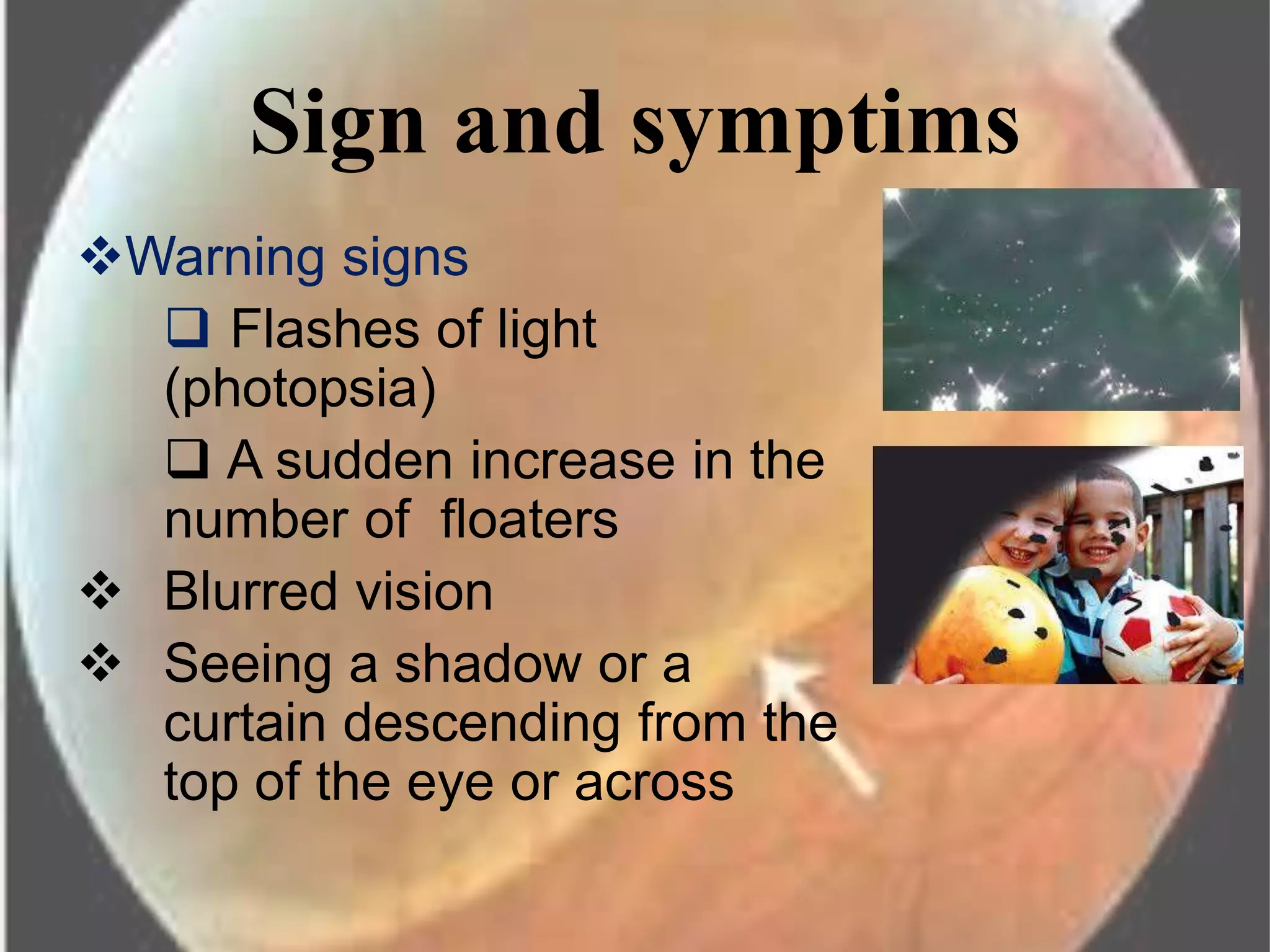 Retinal detachment new | PPTX