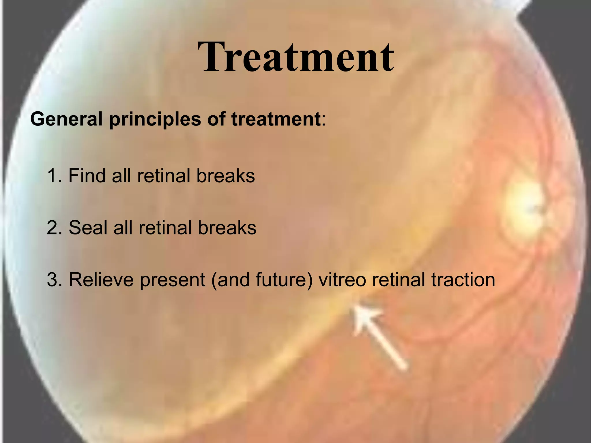 Retinal detachment new | PPTX