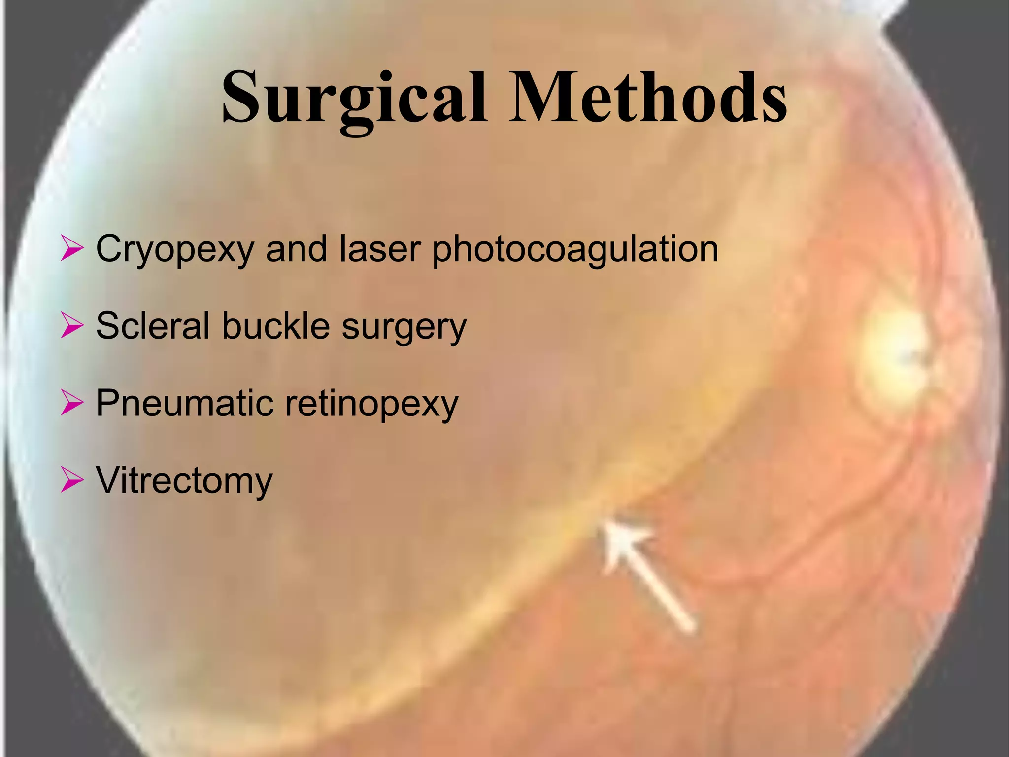 Retinal detachment new | PPTX