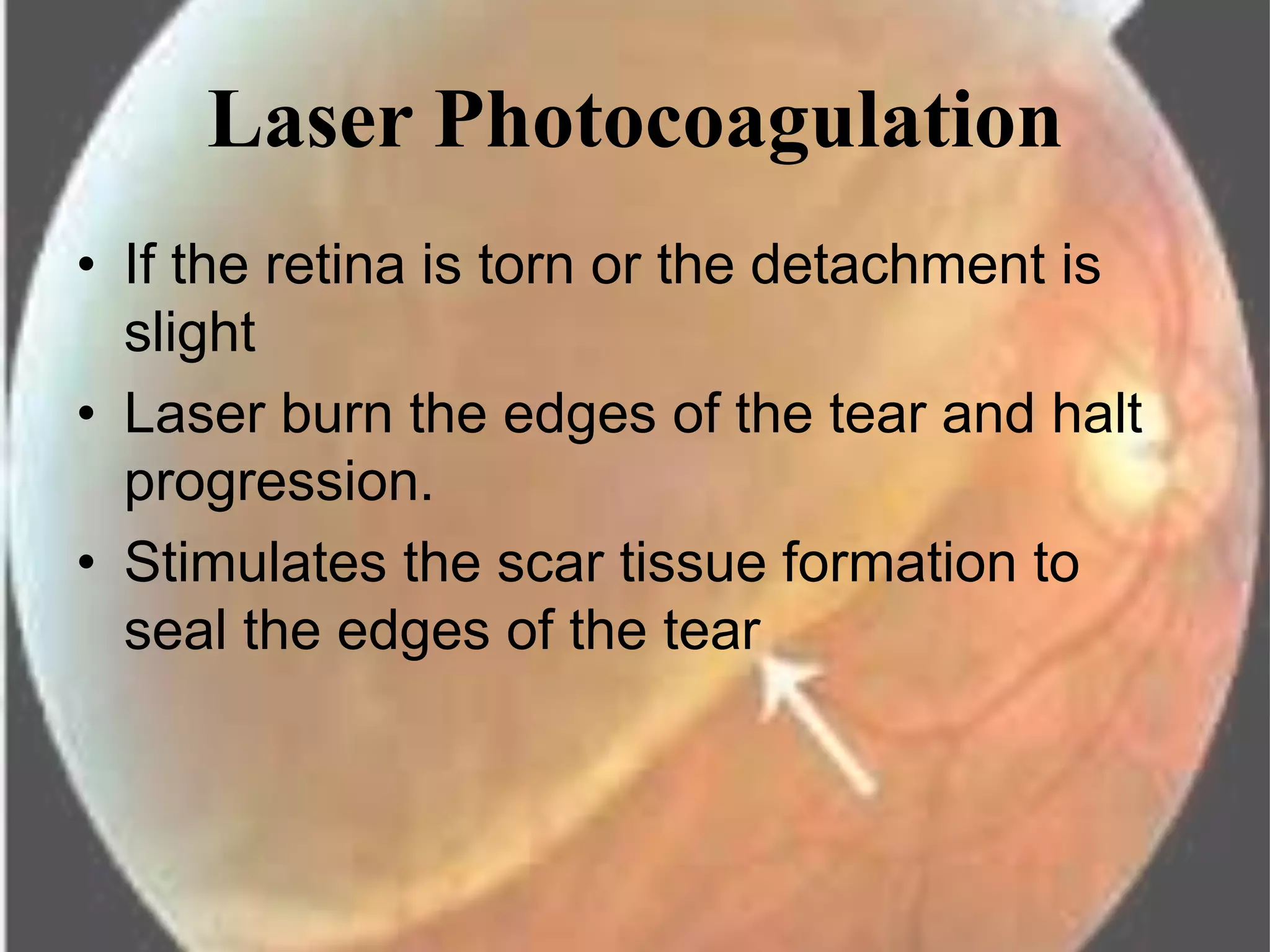 Retinal detachment new | PPTX