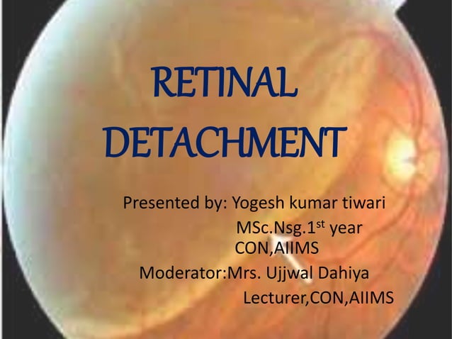 Retinal detachment new | PPTX