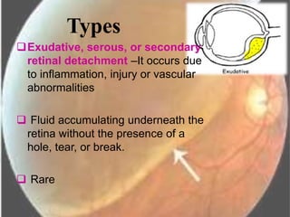Retinal detachment new | PPTX