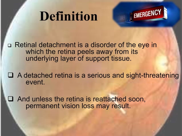 Retinal detachment new | PPTX