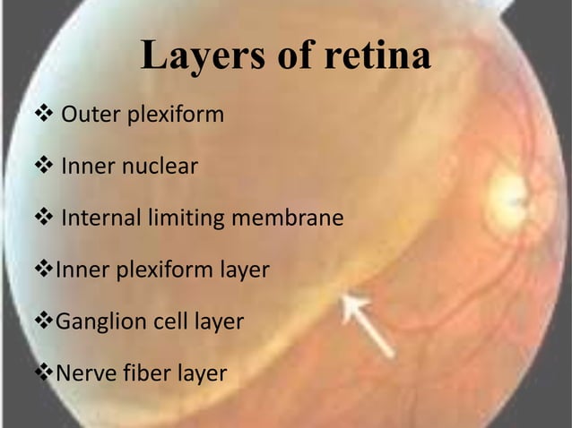 Retinal detachment new | PPTX
