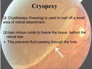 Retinal detachment new | PPT