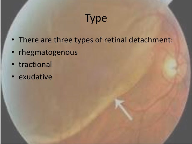 Retinal detachment new