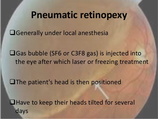 Retinal detachment new