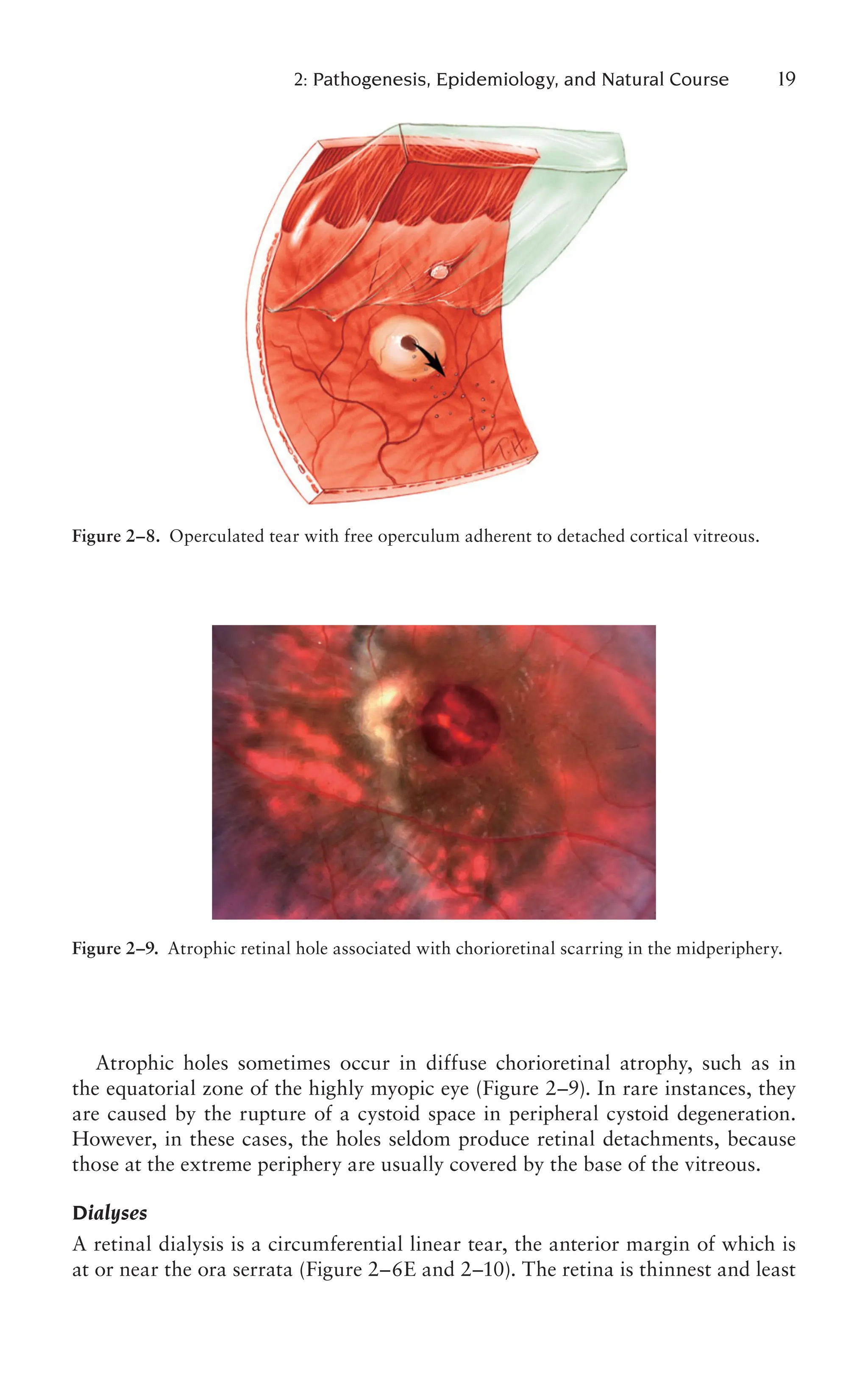 Retinal Detachment Principles and Practice 3rd Ed.pdf