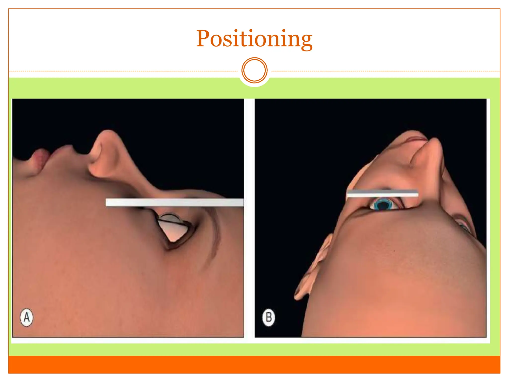 RETINAL DETACHMENT SURGERY 2.pptx