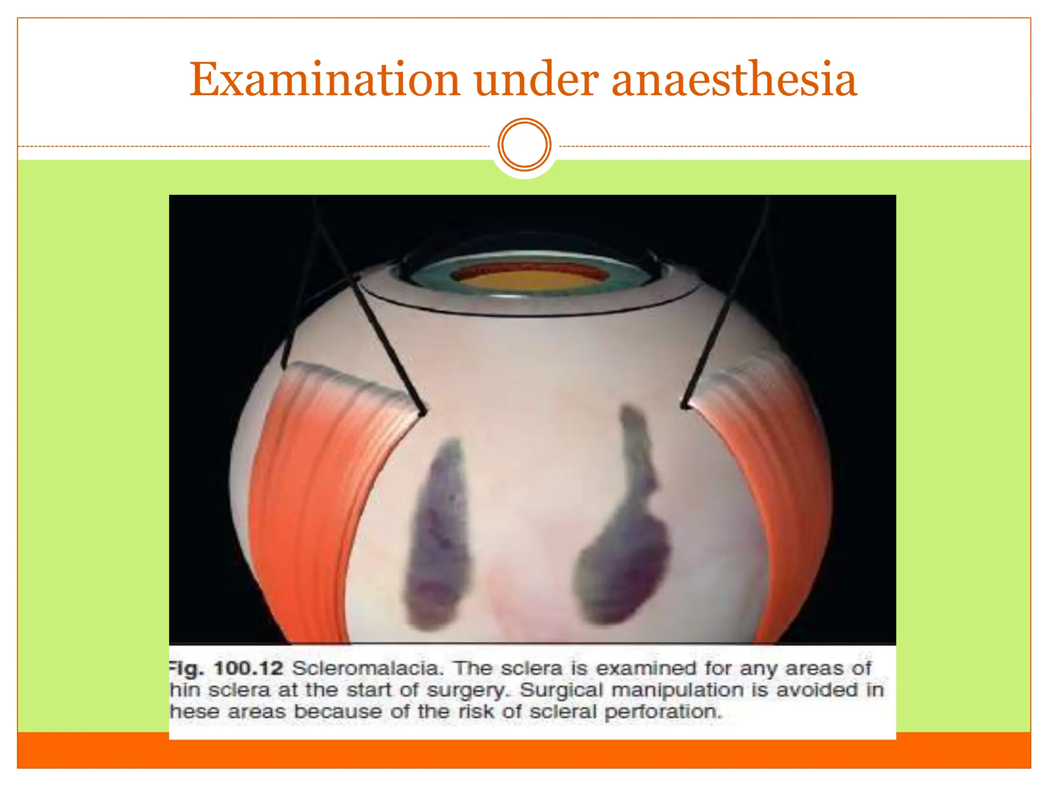 RETINAL DETACHMENT SURGERY 2.pptx
