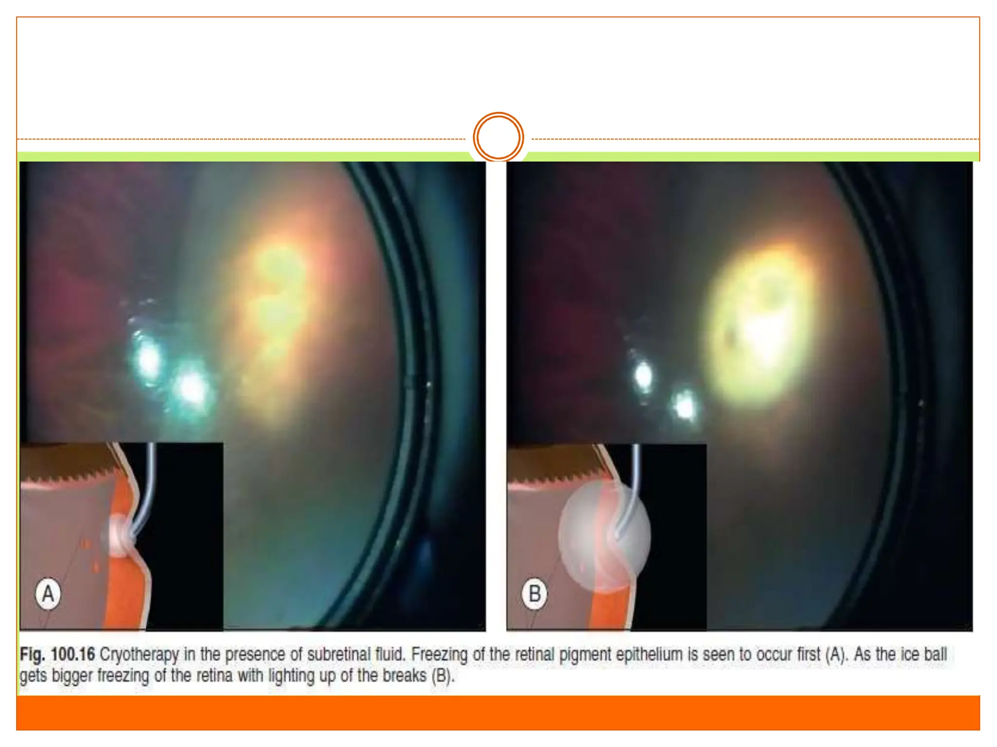 RETINAL DETACHMENT SURGERY 2.pptx