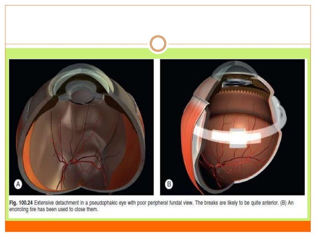 RETINAL DETACHMENT SURGERY 2.pptx