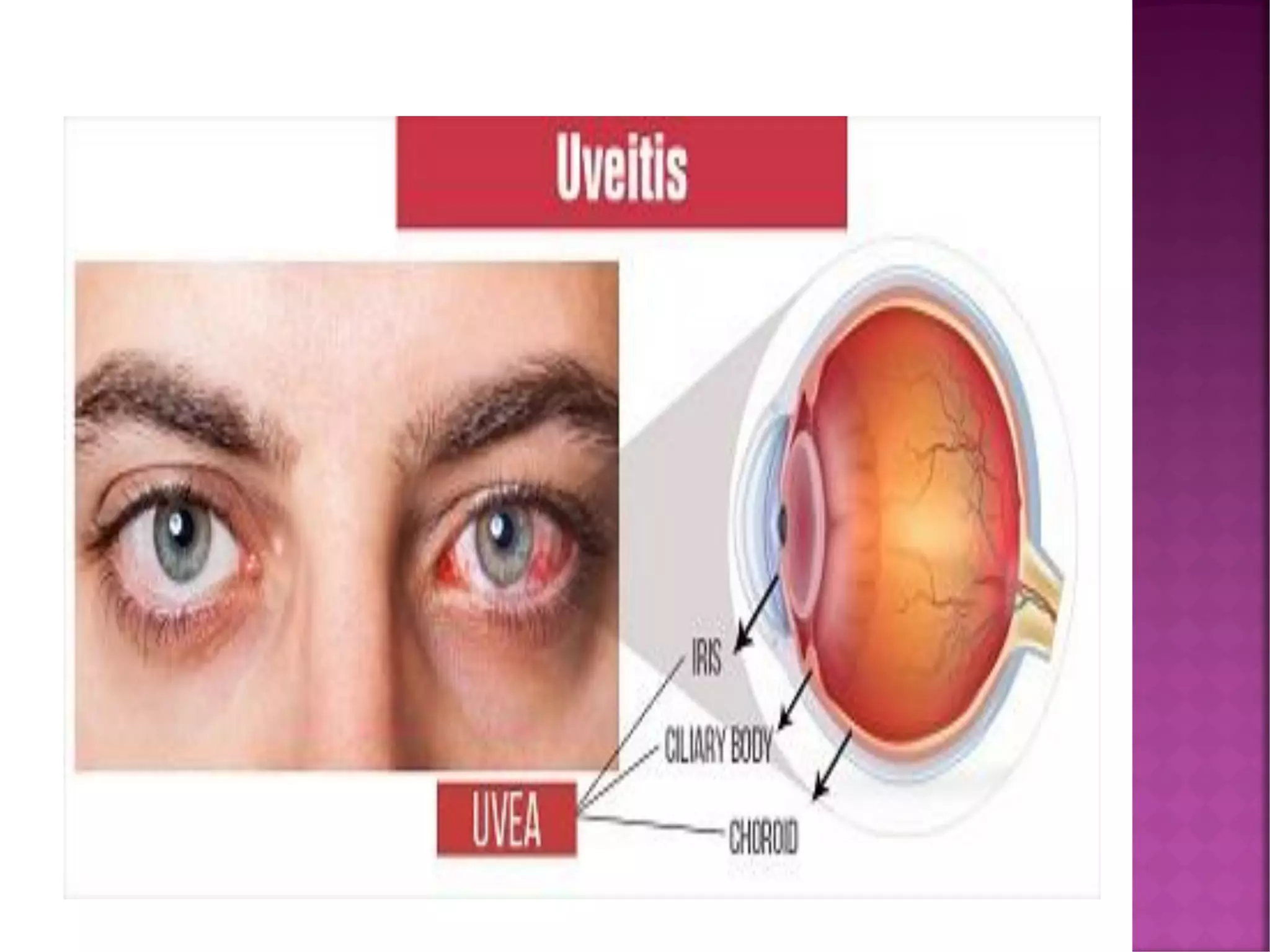 Retinal detachment & uveitis | PDF | Eye and Vision Conditions | Diseases and Conditions