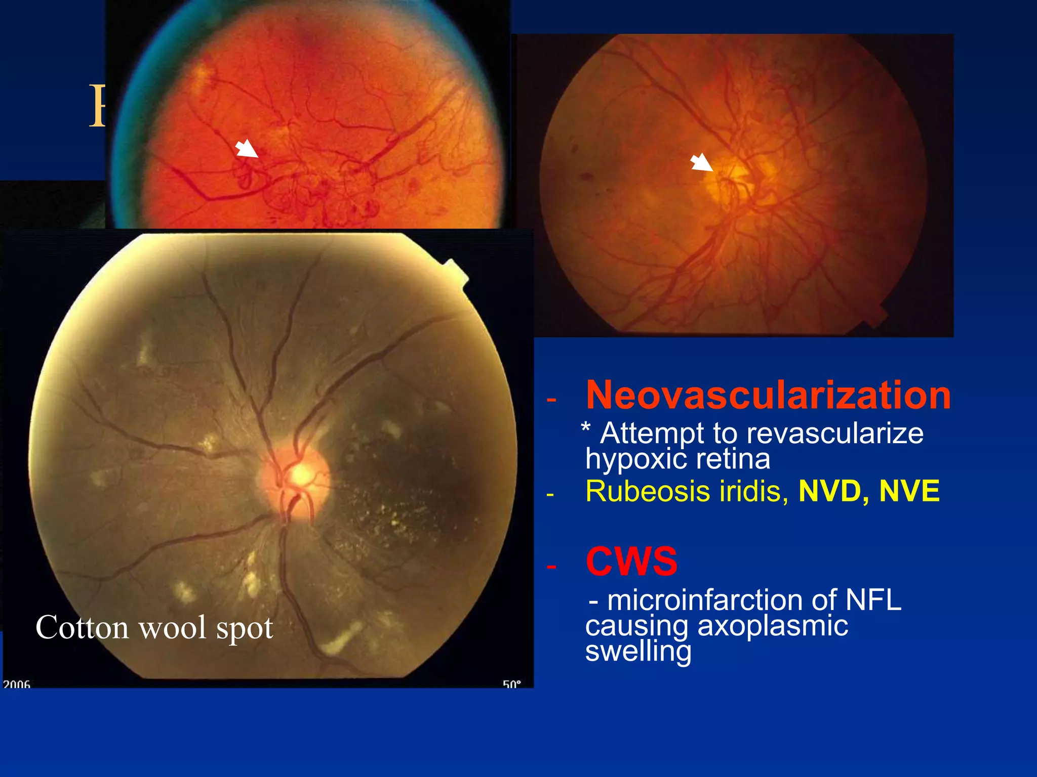 Retinal disease lecture. Optometry. Optometri. | PPT