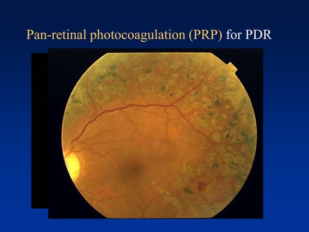 Retinal disease lecture. Optometry. Optometri. | PPT