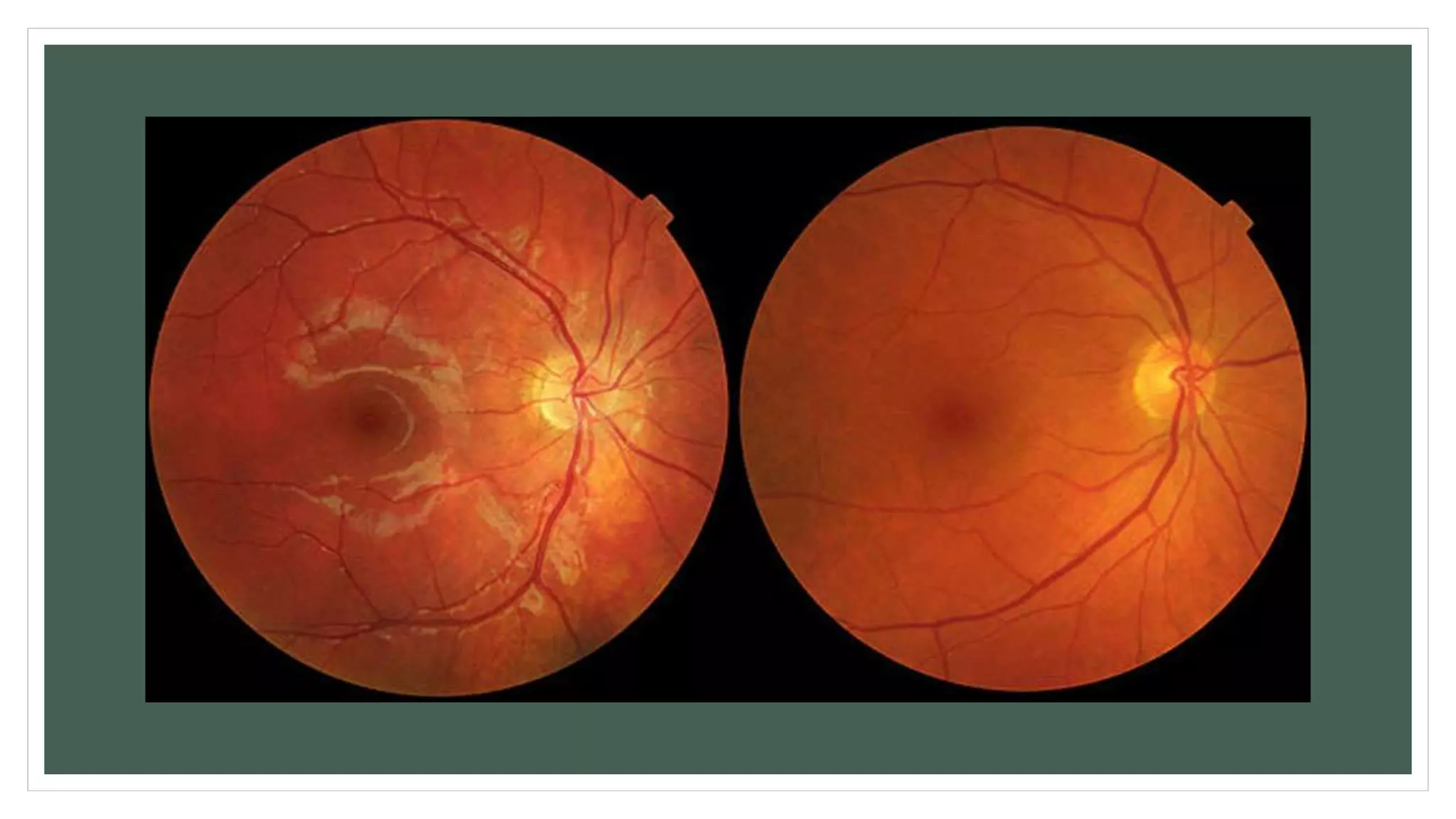 Retinal diseases of eye | PPTX
