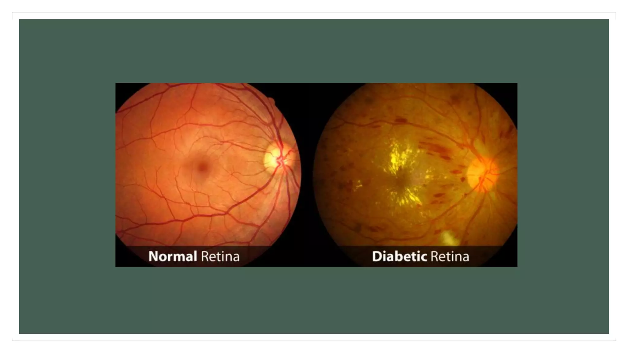 Retinal diseases of eye | PPTX