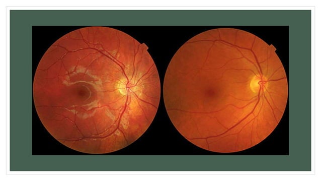 Retinal diseases of eye | PPTX | Eye and Vision Conditions | Diseases ...