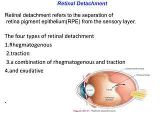 Retinal disorders | PPTX