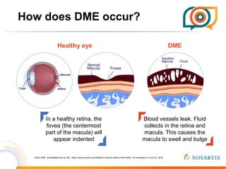 Retinal disorders DME | PPTX